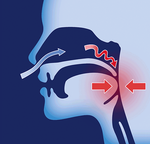 Pisces Healthcare Solutions. Mandibular Advancement Device for Sleep Apnea